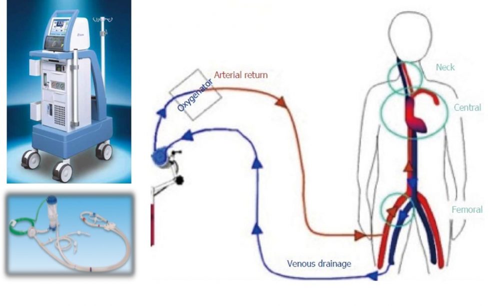 ECMO(体外式膜型人工肺 ≒ PCPS：経皮的心肺補助) | 西宮渡辺心臓脳・血管センター