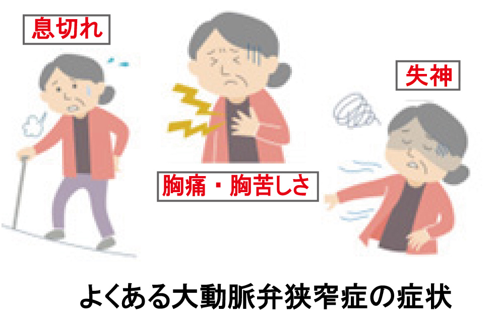 TAVI（経カテーテル大動脈弁置換術） | 西宮渡辺心臓脳・血管センター